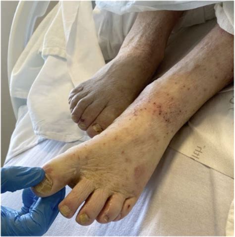 Crusted Scabies At A Tertiary Care Center Case Series And Cautionary