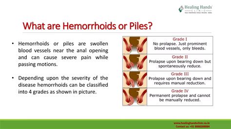 11 Self Care Tips To Prevent Hemorrhoids Pptx