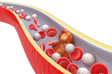 Cholesterol Plaque In Artery Stock Illustration Illustration Of Body Problem