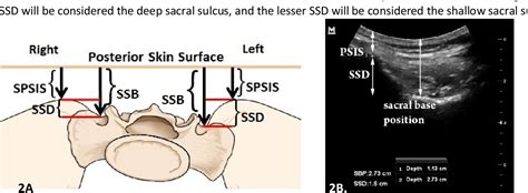 Sacral Sulcus Landmark