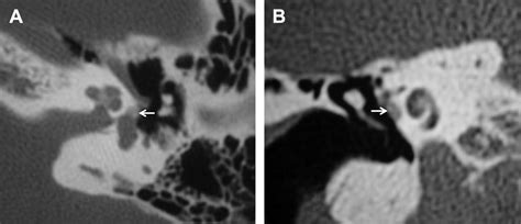 Otoscopy Schwartze Sign Otosclerosis