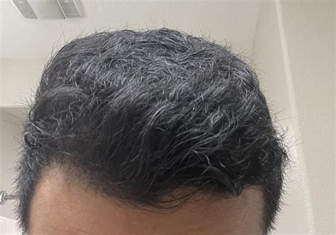 Minoxidil Ketoconazole Gives Me Scalp Irritability Should I Push Through R Minoxidil
