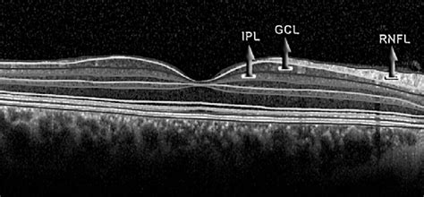 Measurement Of The Gcl And Ipl Thicknesses With Spectral Oct Gcl Download Scientific Diagram