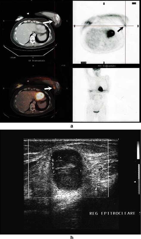 Structure Of Epitrochlear Lymph Node Semantic Scholar
