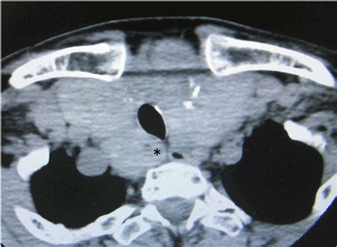 Tracheal Stenosis Due To Huge Adenomatous Goiter