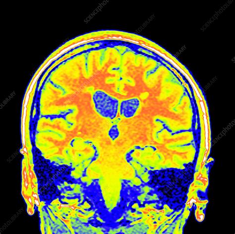 Multiple Sclerosis Brain MRI Stock Image M210 0189 Science Photo