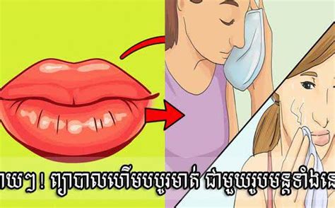 ហើមបបូរមាត់មែនទេ កុំរំលងអត្ថបទនេះ Tnaot