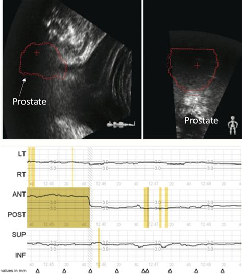 The Clarity Ultrasound System Monitors The Corrective Action Performed