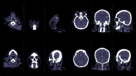 脑动脉ct血管造影术。视频素材下载