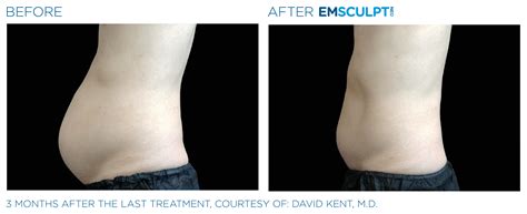 Emsculpt Neo® Kimberly Schmid Md