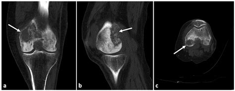 Joint Effusion Treatment Knee Effusion Synovitis Volume Measurement
