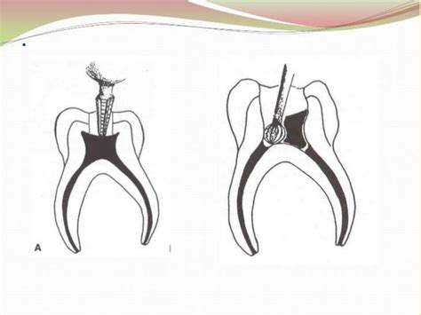 Difference Between Pulpotomy And Pulpectomy
