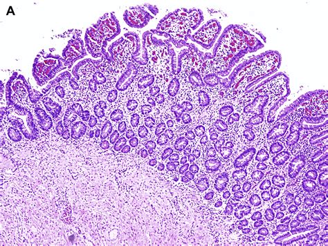 Diagnoses And Difficulties In Mesenteric Pathology Surgical Pathology