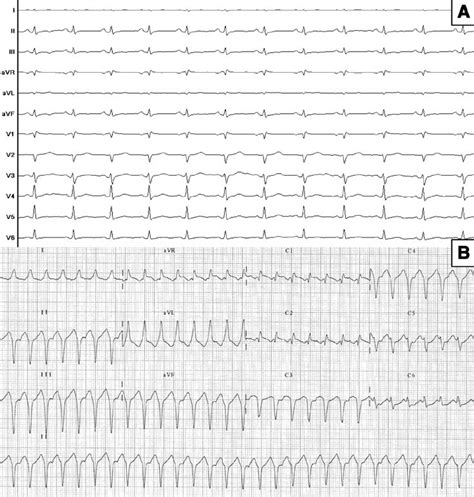 Figure 2 From Impact Of Septal Radiofrequency Ventricular Tachycardia