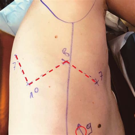 Port Position For The Right Side Approach Camera Port In The 8th Inter