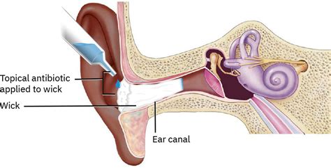 142 Administering Ear Medications Medicine Libretexts