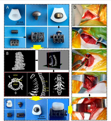 Figure 1 From Cervical Subtotal Discectomy Prosthesis Validated In Non