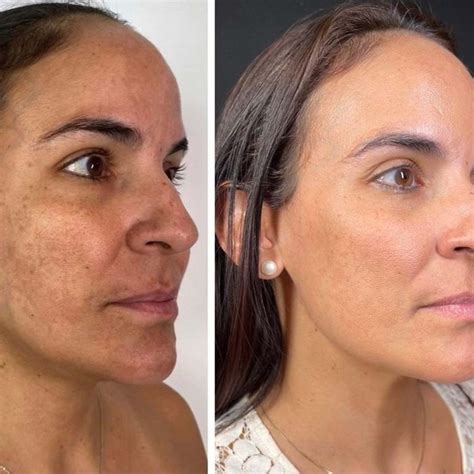 Mandelic Acid Peel Benefits Safety Costs And Side Effects