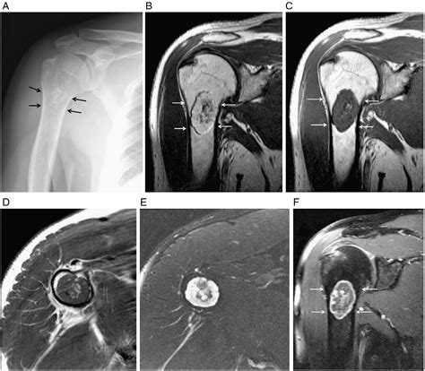 Chondrosarcoma Mri