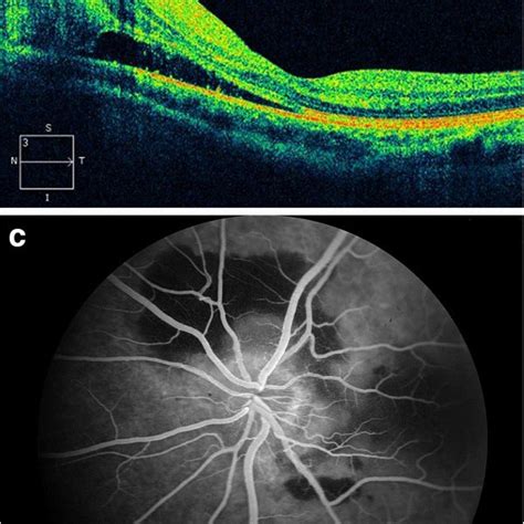 Literature Summary Of Choroidal Neovascularization In Intermediate Uveitis Download Table