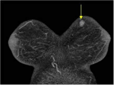 Breast And Axilla 5 2 Malignant Breast Lesions Case 5 2 6 Metastases In The Breast