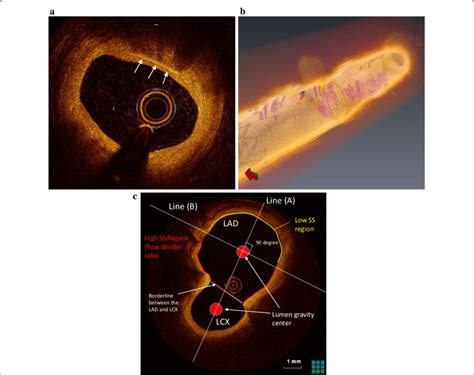 Oct Analysis Of Macrophage Accumulation A Representative Download