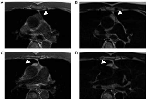 Magnetic Resonance Images Showing A 28 Mm Bilocular Cyst White Arrow