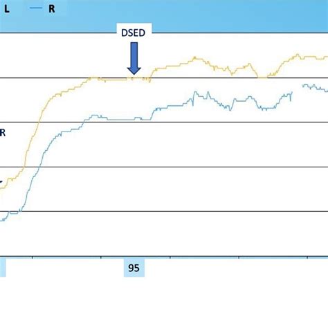 Near Infrared Spectroscopy Cerebral Oximetry Values From The Mic