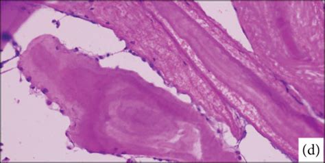 Gross Specimens Of The Resected Subaortic Membrane A And Mass B