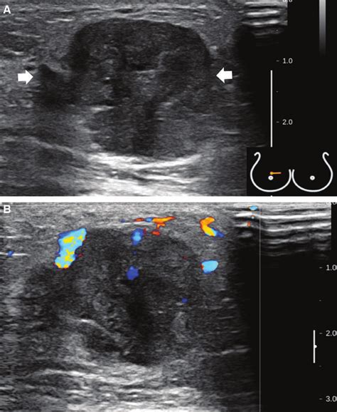 A A 3 4 × 2 3 Cm Irregularand Heterogeneous Echoic Mass Arrows With Download Scientific