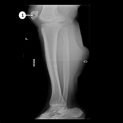 Walanglabelangtibiaatfibula