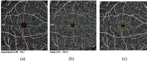 Figure 1 From Application Of Angio Optical Coherence Tomography And