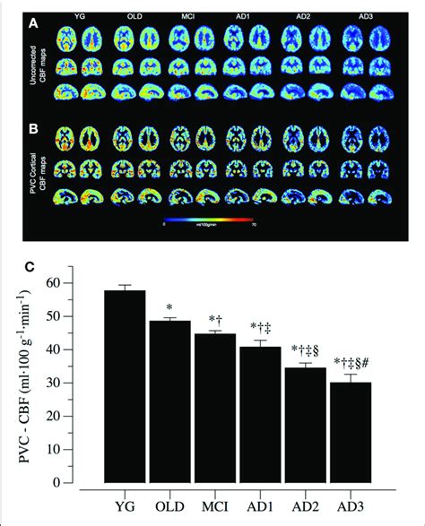 Cortical Perfusion Data A Group Whole Brain Uncorrected Cerebral