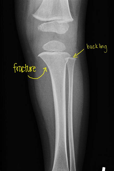 Occult Tibial Plateau Fracture Aslopeer