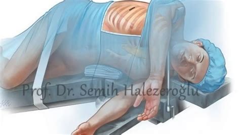 Single Port Thoracoscopy Surgery In Lung Cancer