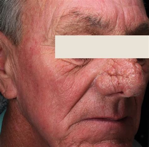 Laser Treatment For Rhinophyma — Northern Sydney Dermatology Nsdl
