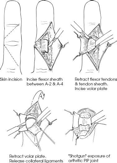 Osteoarthrits Proximal Interphalangeal Joint Silastic Implants Musculoskeletal Key