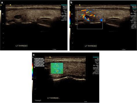 A An Example Of A B Mode Image Of A Hypoechoic Thyroid Nodule In The Download Scientific