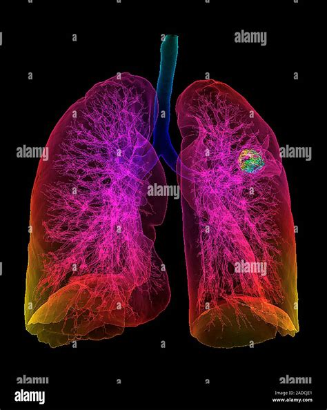 Lung Cancer Coloured 3d Frontal Computed Tomography Ct Scan Of Human Lungs With A Cancer