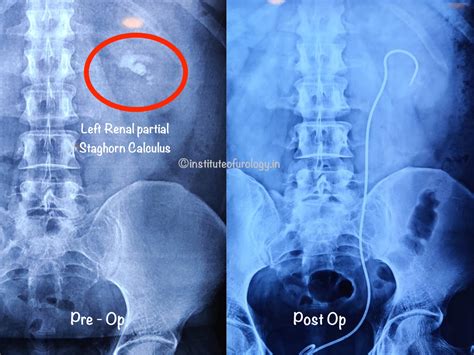 Renal Staghorn Calculus Treatment By Rirs At Institute Of Urology Jaipur