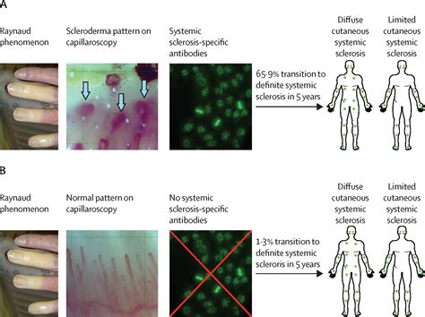 Scleroderma In Lungs Life Expectancy