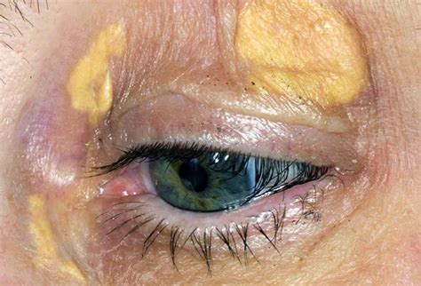 Xanthomatosis Xanthoma