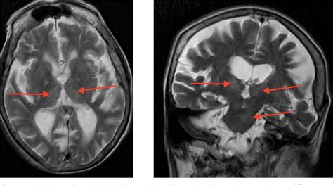 Figure 1 From Osmotic Demyelination Syndrome Following Slow Correction Of Hyponatraemia