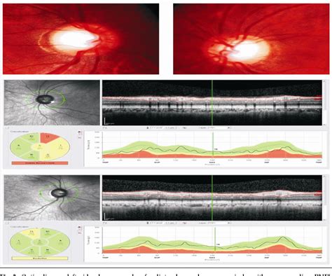 Figure 1 From Role Of Oct In Diagnosis And Progression Of Glaucoma Semantic Scholar
