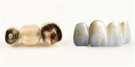 Good Dentistry Bridge Vs Bad What Makes The Difference