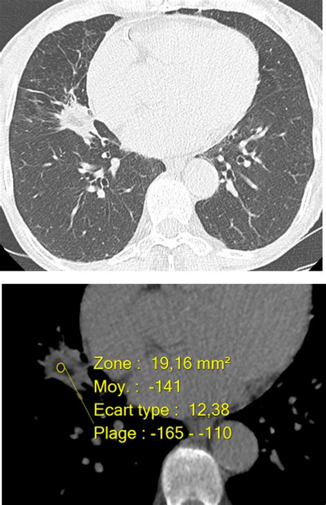 Nodules Pulmonaires Trucs Et Astuces Sfr