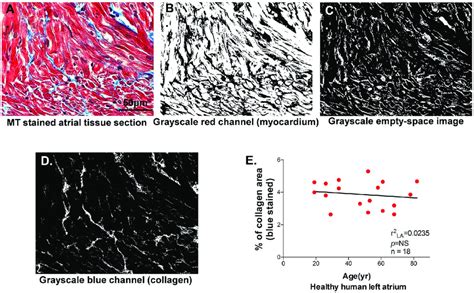 Matlab Based Algorithm Designed To Detect Interstitial Collagen