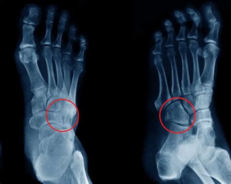 cuboid fracture healing