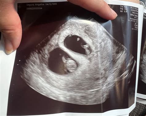 Vanishing Twin Syndrome Symptoms