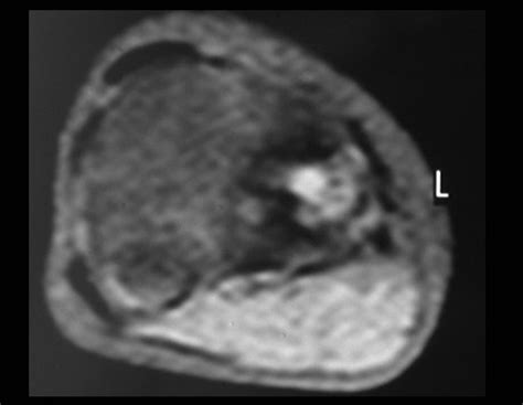 Osteosarcoma De La Tibia Prótesis Parcial Rotatoria Oncocirugia